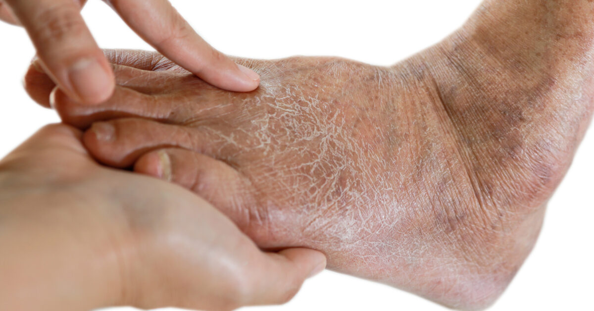 What Is The Brown Staining On My Legs? | Blog | Chiltern Wellbeing