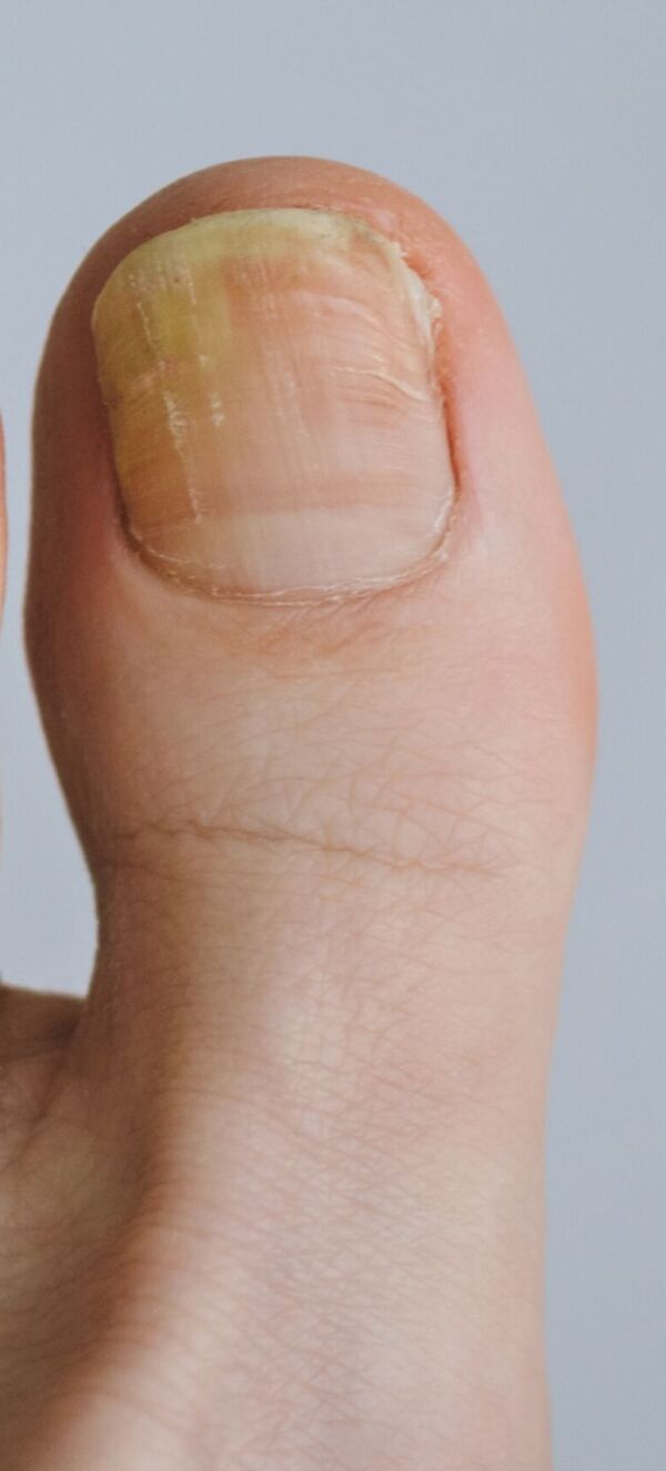 Symptoms of Fungal Nails | Fungal Nails | Chiltern Wellbeing